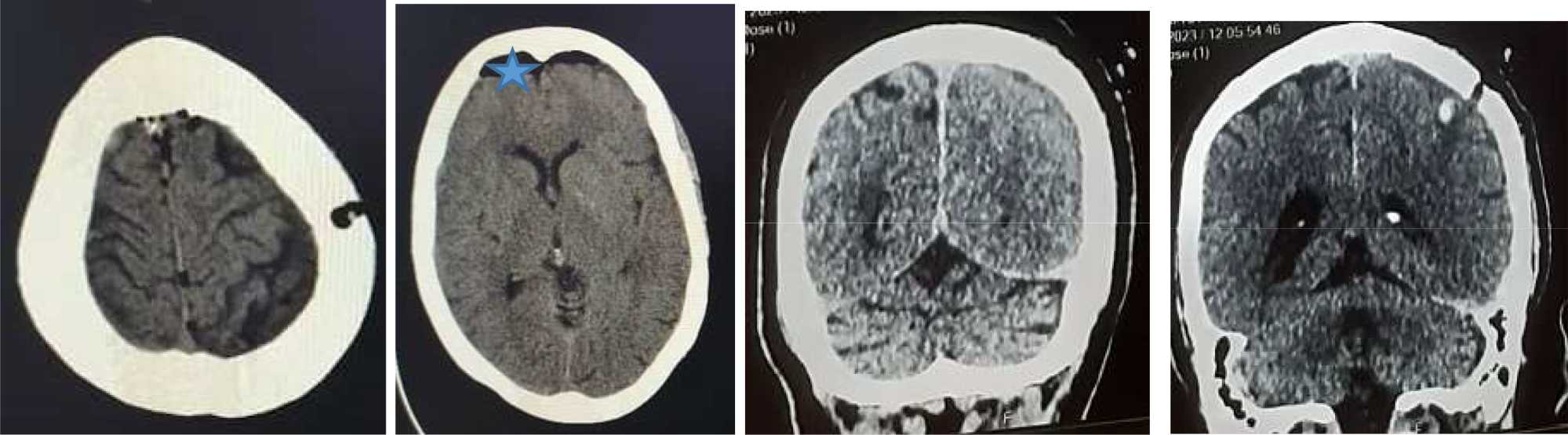 Left Hemispherical Subdural Hematoma on the Same Side as the Motor ...