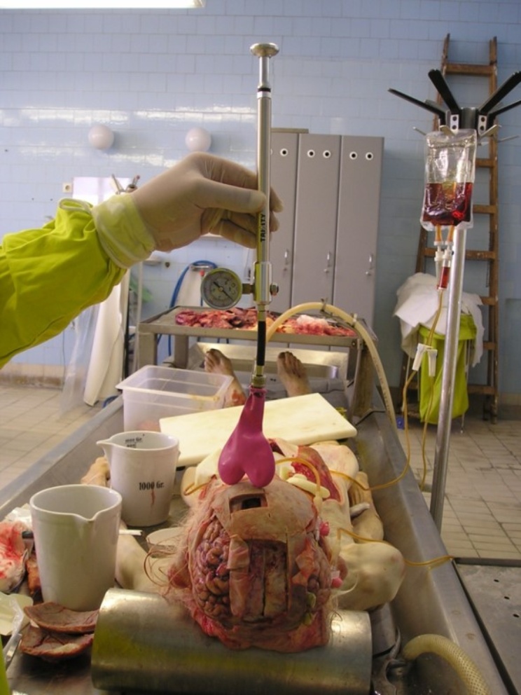 Which Type of Decompressive Craniectomy Is Better? Advantages and ...