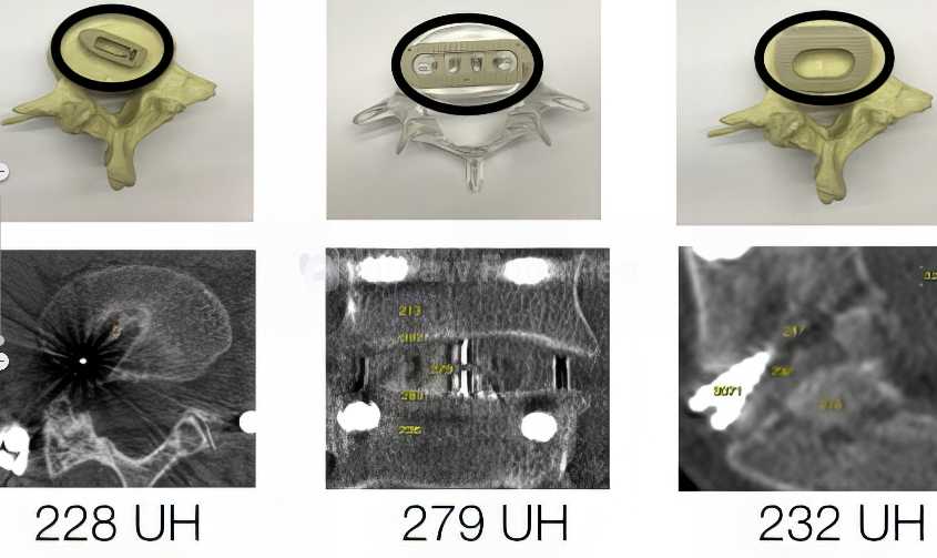 Implementing P-15/ABM Bone Graft as a Standardized Technique for Lumbar ...