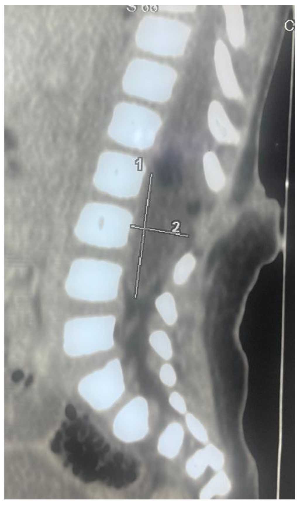 A Case Report of Congenital Dermal Sinus Tract with Dermoid Cyst and Lipoma