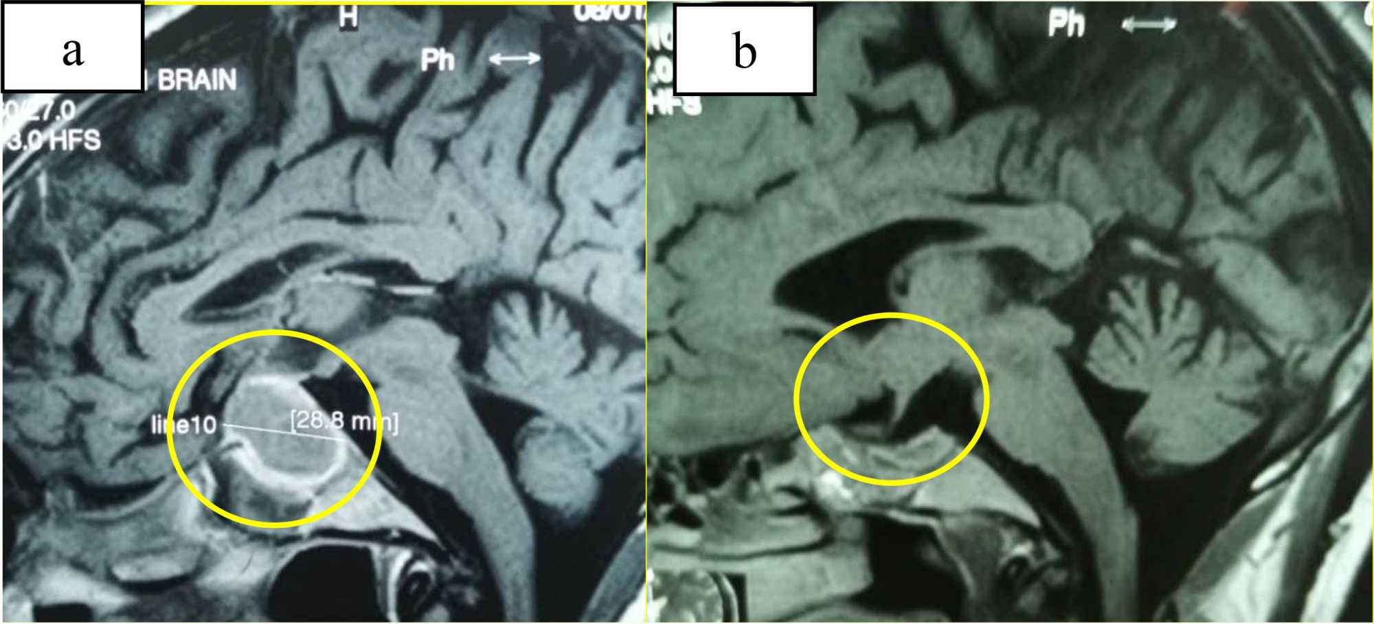 Pituitary Apoplexy in Pituitary Adenoma: About 16 Cases