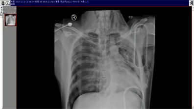 Emergency Treatment and Nursing Care of a Patient with Multiple ...