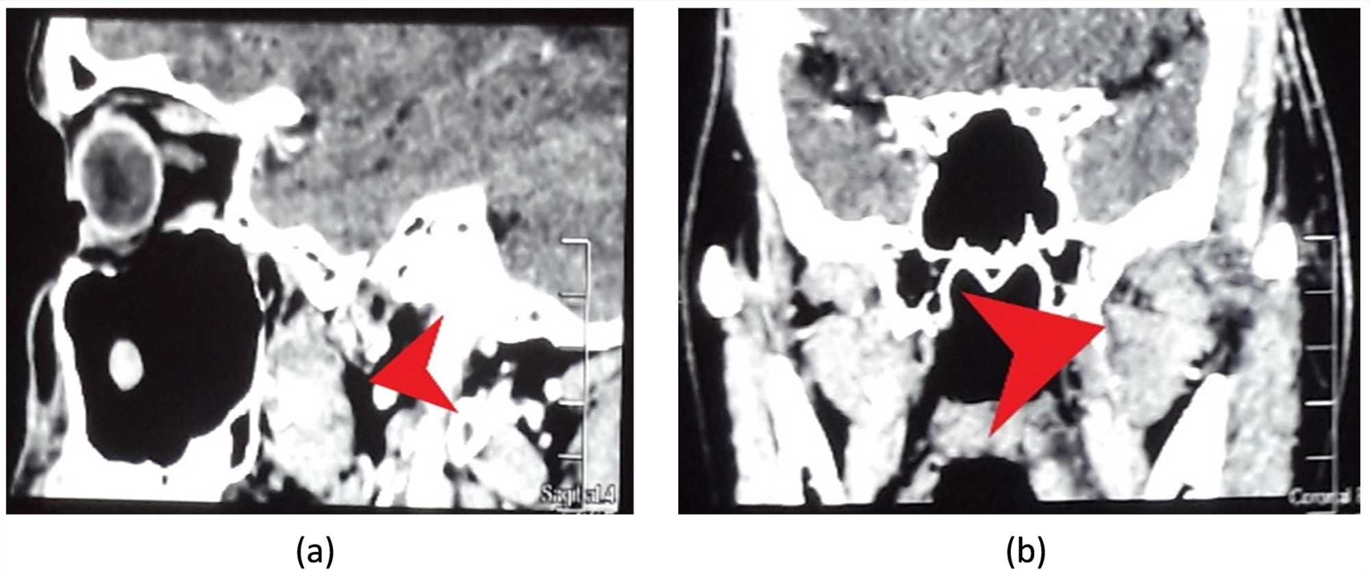 Cerebellar Abscess of Otogenic Origin in a Case