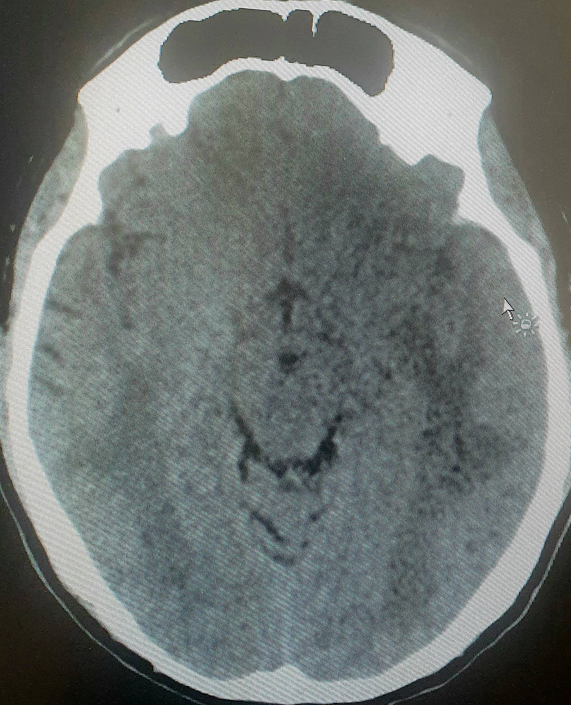 Reversible Posterior Encephalopathy Syndrome (PRES)