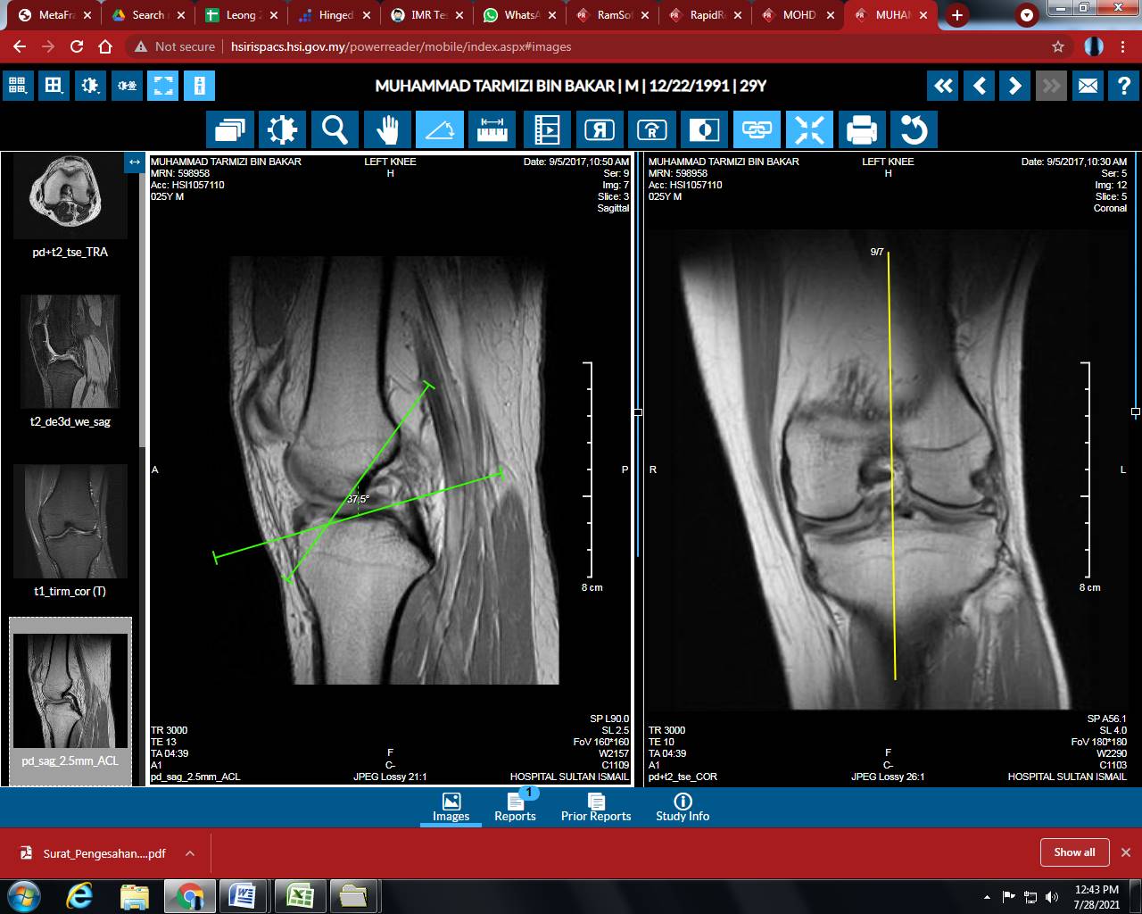 Is Blumensaat Inclination Angle (BIA) and Angle between Blumensaat line and Tibal Slope (BATS) a ...
