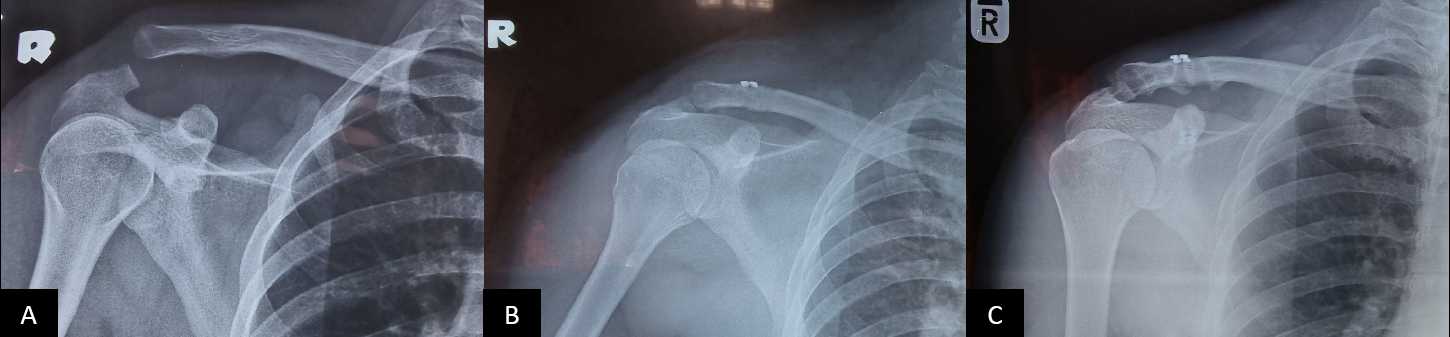 A Case Series of Arthroscopically Assisted Anatomical Coracoclavicular ...
