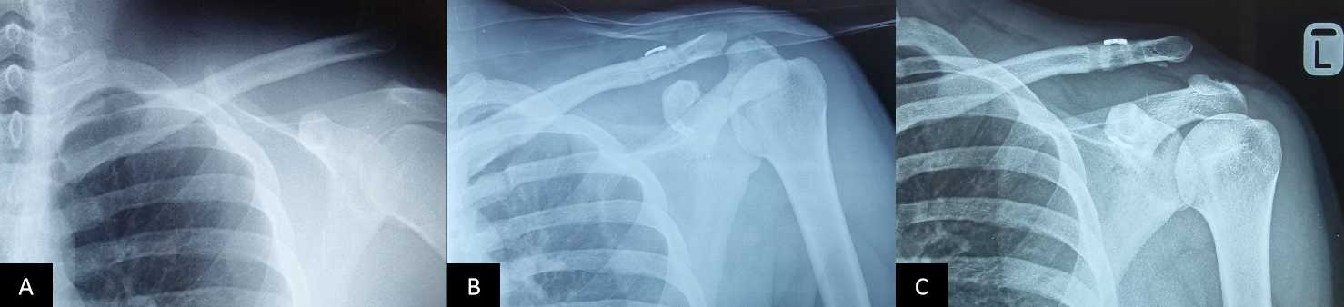 A Case Series of Arthroscopically Assisted Anatomical Coracoclavicular ...