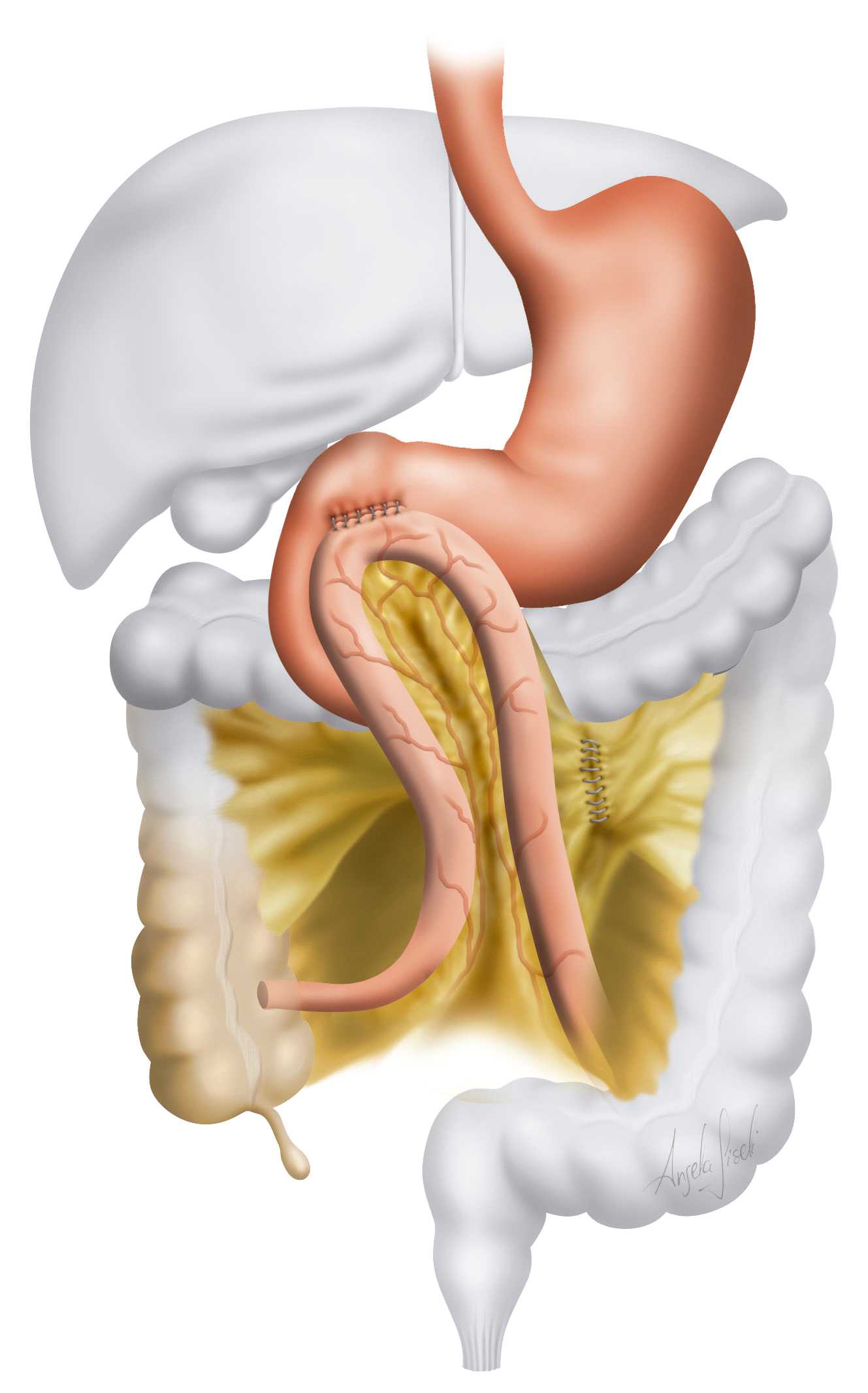 Metabolic Surgery: Concepts and New Classification
