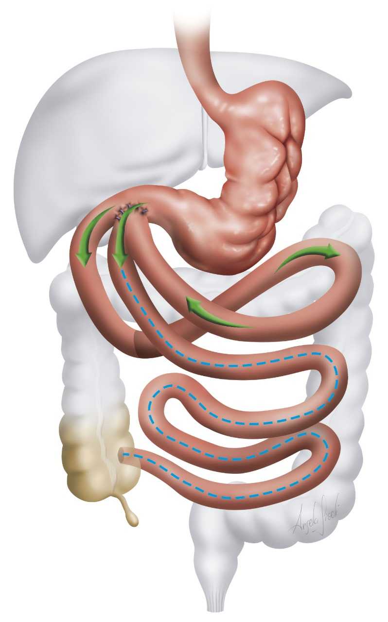 Metabolic Surgery: Concepts and New Classification