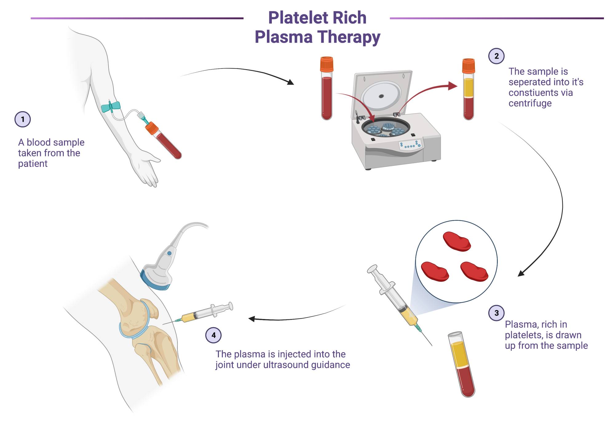 The Use of Biologic Treatments for Osteoarthritis: A Review