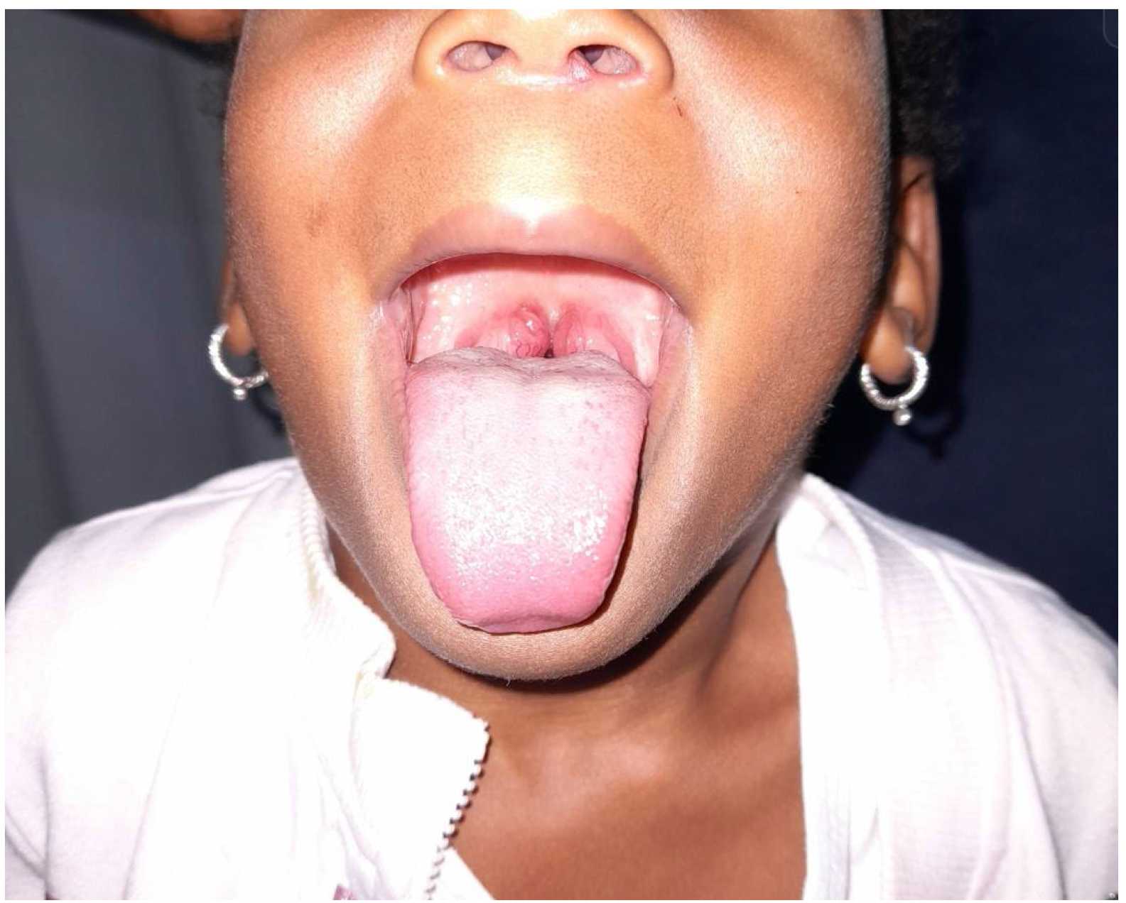 Tonsil Surgery in the Management of Obstructive Sleep Apnea-Hypopnea ...