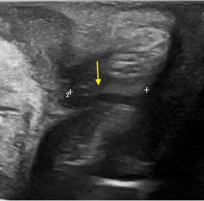 Vulvar Swelling in a 12-Year-Old Girl: An Early Manifestation of Crohn ...
