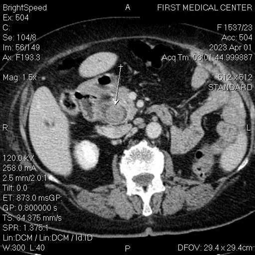 Choledocholithiasis Complicated by Cholangitis and Cholecystitis in A ...