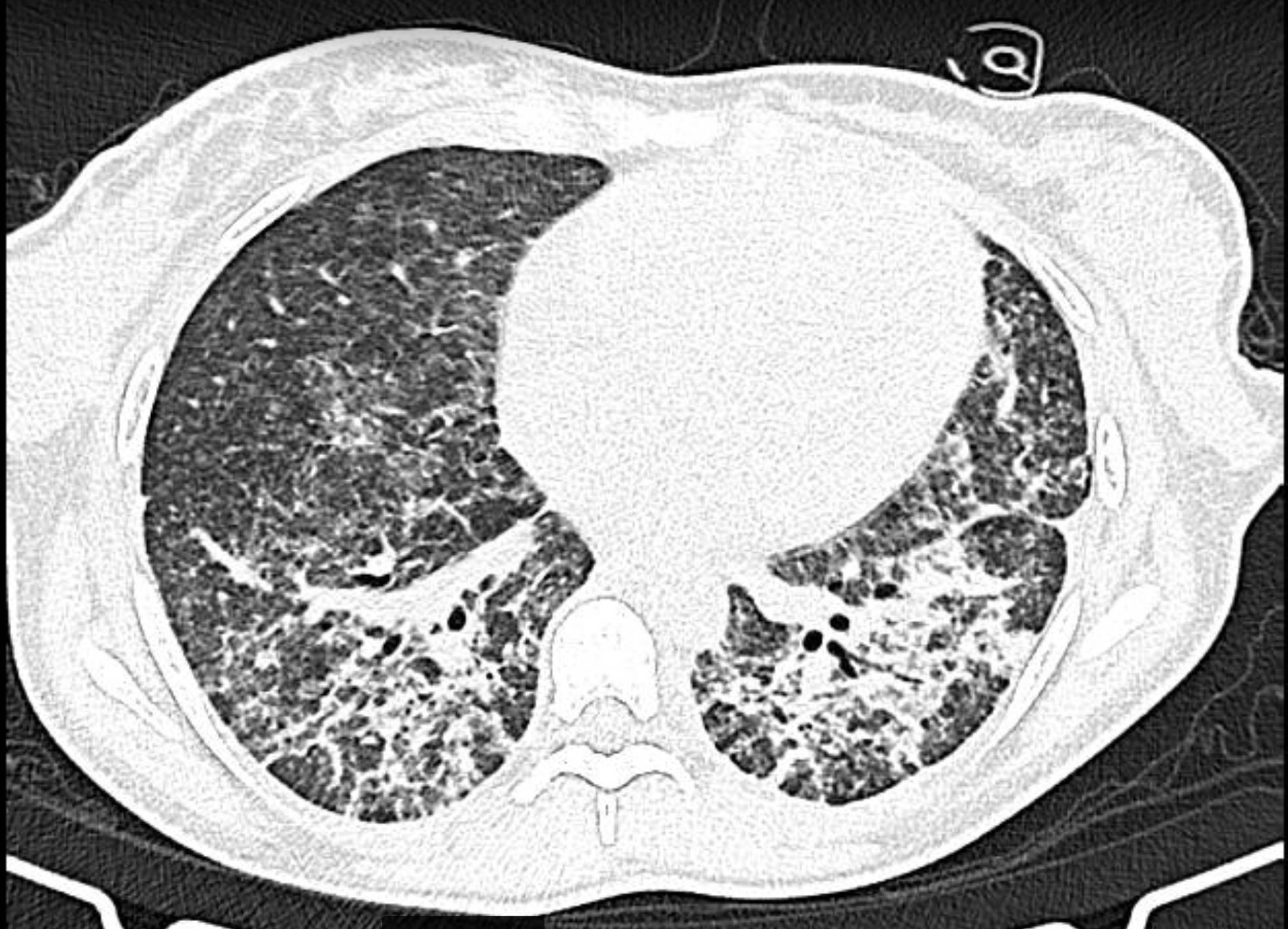 Congenital Tuberculosis: A Diagnostic Challenge that Stems from the Mother