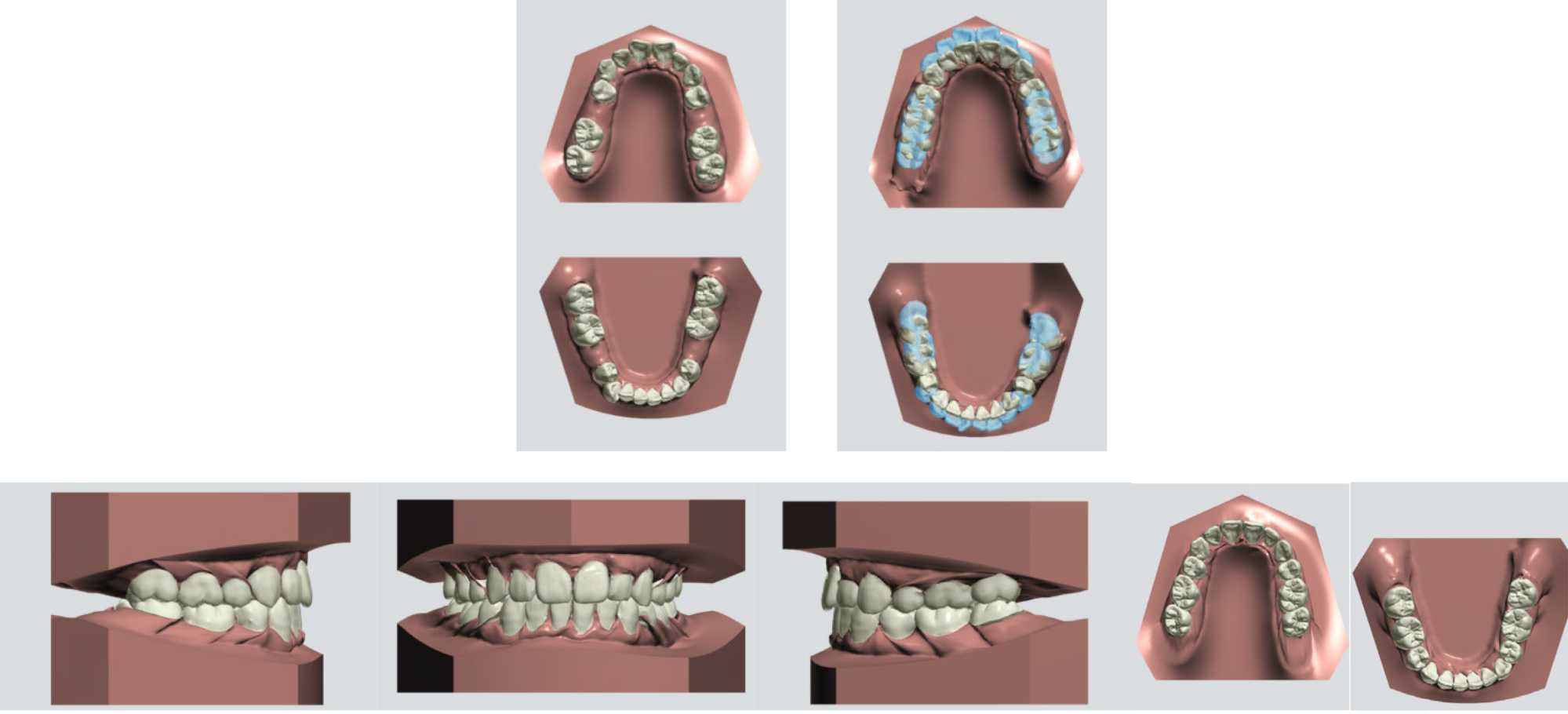 Digital Tooth Alignment VTO-Assisted Treatment of an Adult with Class I ...