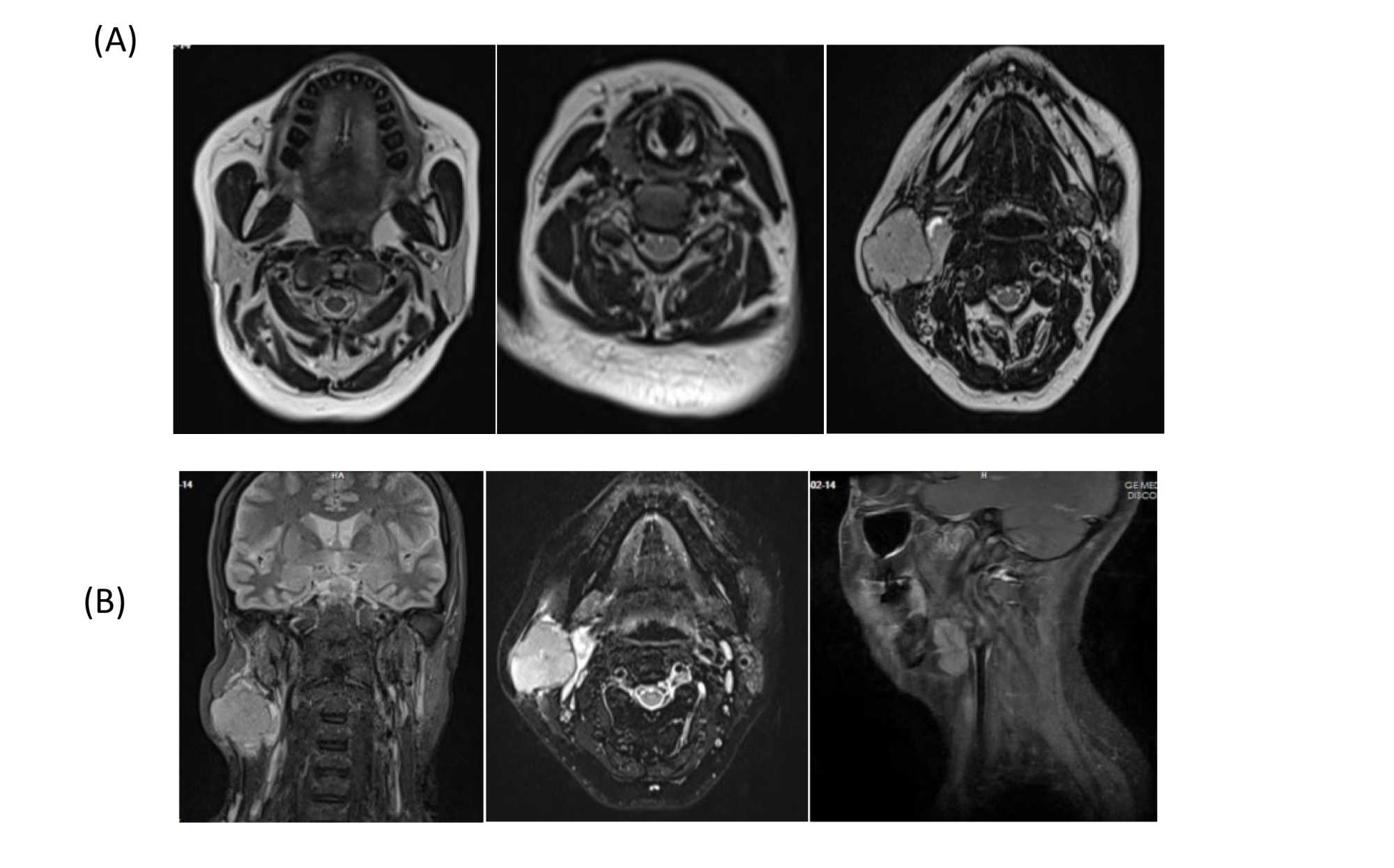 A Rare Case of Myoepithelial Carcinoma Associated with Recurrent ...