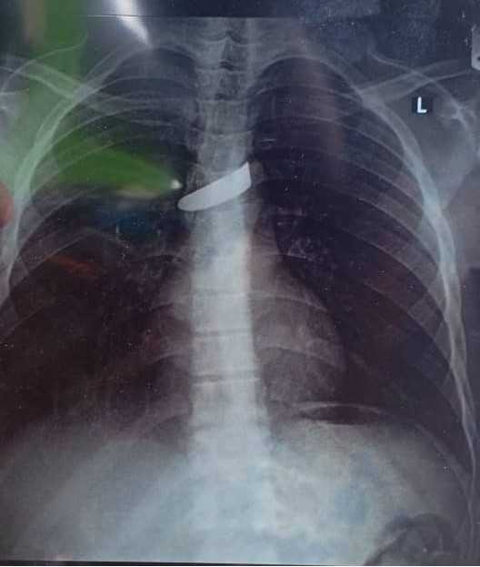 Impalement Injury to the Thoracic Spine and Lung (A Case Report)
