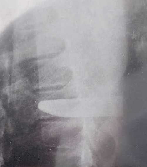 Impalement Injury to the Thoracic Spine and Lung (A Case Report)
