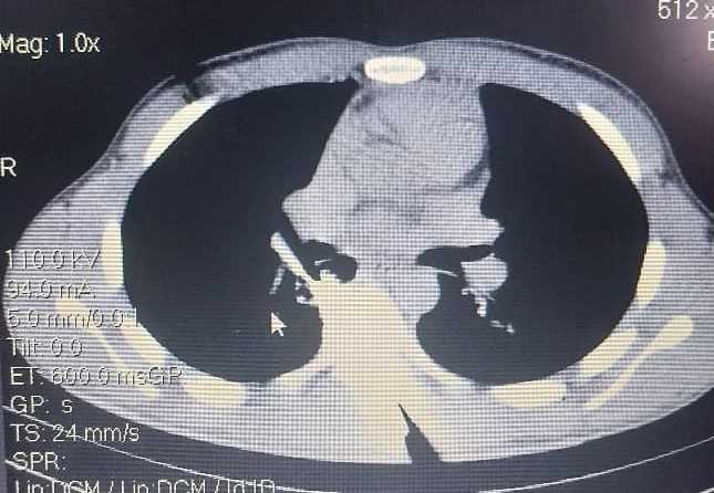 Impalement Injury to the Thoracic Spine and Lung (A Case Report)