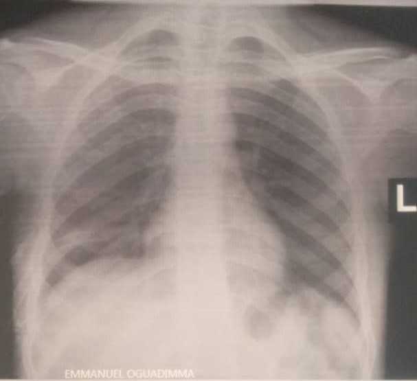 Impalement Injury to the Thoracic Spine and Lung (A Case Report)