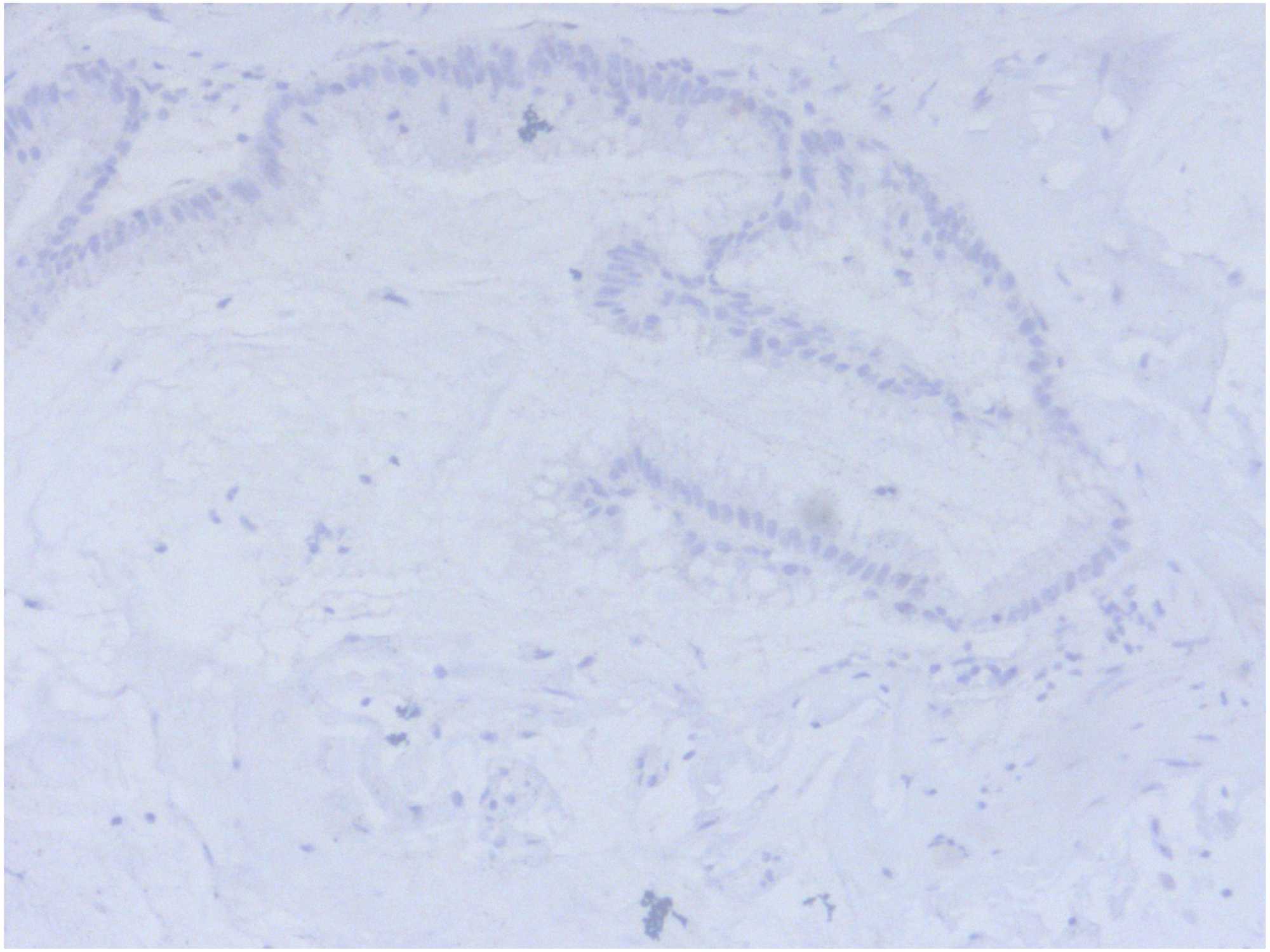 A Case of Diagnosis of Pseudomyxoma Peritonei