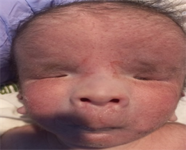 Fraser Syndrome: A Case Report