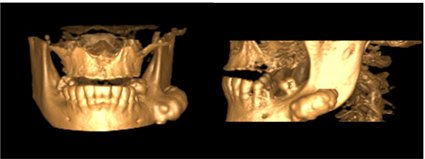 Facial Asymmetry Caused by Mandibular Osteoma: Case Report