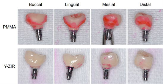 A Study of Plaque Adhesion during Implant Treatment of Missing Molars