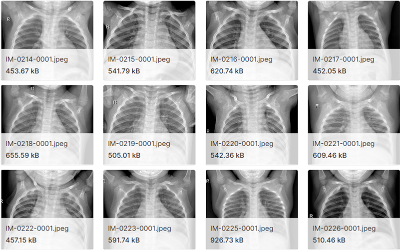 COVID-19 Detection from Chest X-Ray Images Using Convolutional Neural ...