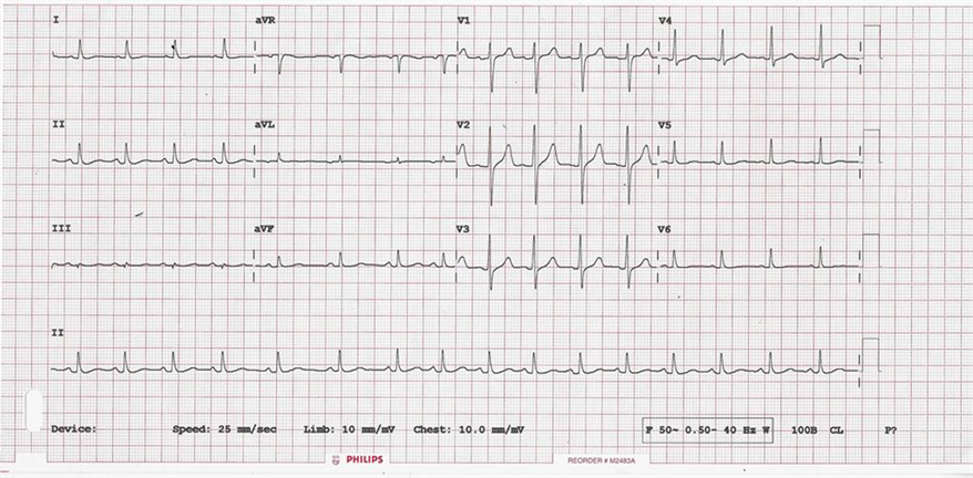 A Case of Euglycemic Diabetic Ketoacidosis in Patient with Type 2 DM