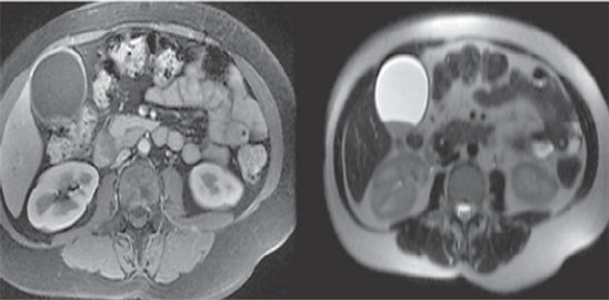 Ileo-Ileal Intussusception Caused by an Inflammatory Fibroid Polyp: A ...