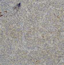 Mixed Neuroendocrine-Non-Neuroendocrine Neoplasm (MiNEN) of the Colon ...