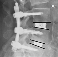 Retrospective Case Series of Porous Titanium Cages in Oblique Lumbar ...
