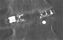 Retrospective Case Series of Porous Titanium Cages in Oblique Lumbar ...