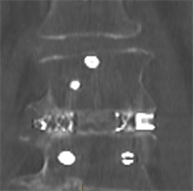 Retrospective Case Series of Porous Titanium Cages in Oblique Lumbar ...