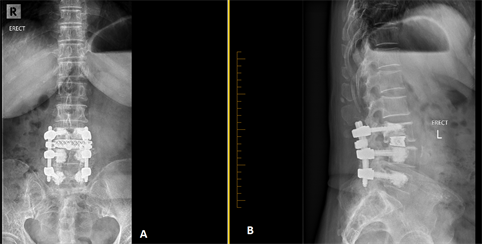 Retrospective Case Series of Porous Titanium Cages in Oblique Lumbar ...