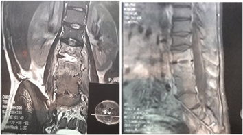 “FISH VERTEBRA” about 3 Sickle Cell Patients Followed at Laquintinie ...