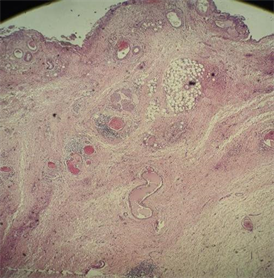 Isolated Esophageal Crohn’s Disease with Diffuse Stricture
