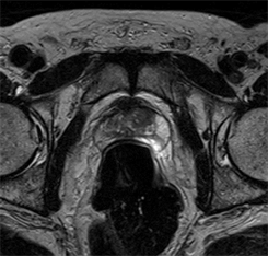 Evaluation of Multiparametric MRI of the Prostate: Impact of ...