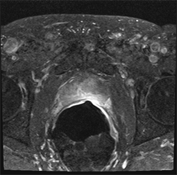 Evaluation of Multiparametric MRI of the Prostate: Impact of ...