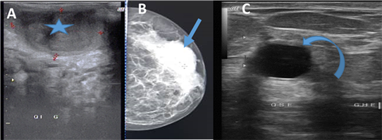 The Epidemiological, Clinical and Radiological (Echography, Mammography ...