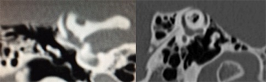 Subtemporal Extradural Approach for Dehiscence of the Superior ...