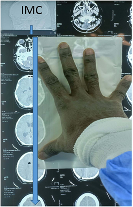 Proposed Simple, Efficient Free Hand Technique for Frontal External ...