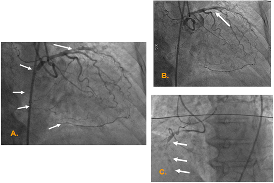 Improved Angina Symptoms Following Coronary Sinus Flow Reducer ...