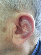 Curaderm, the Long-Awaited Breakthrough for Basal Cell Carcinoma