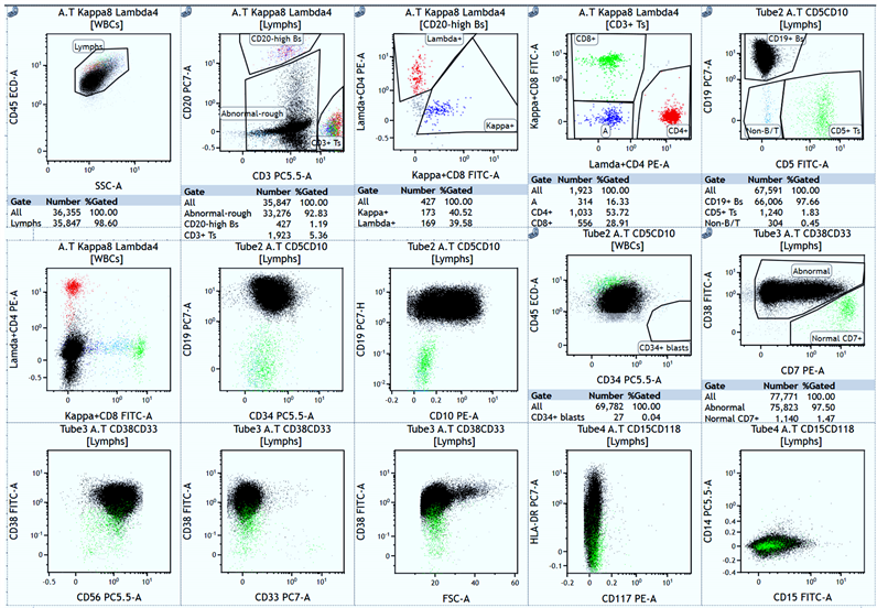 CD34-Negative B-Lymphoblastic Leukemia/Lymphoma Presenting as Cutenous ...