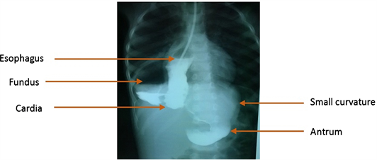 GASTRIC VOLVULUS: A Case Report and Literature Review