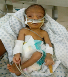 Amniotic Band Syndrome at the Van Norman Clinic in Burundi: A Case Series