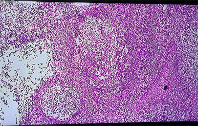 Ethmoidal Polyposis, Adenoid Hypertrophy and Tympanic Membrane ...