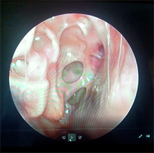 Ethmoidal Polyposis, Adenoid Hypertrophy and Tympanic Membrane ...